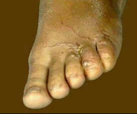 Hookworm | RealClearScience